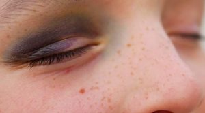 The Bruise Under the Eye – How to Heal it Faster? | Eye Clinic Lirema